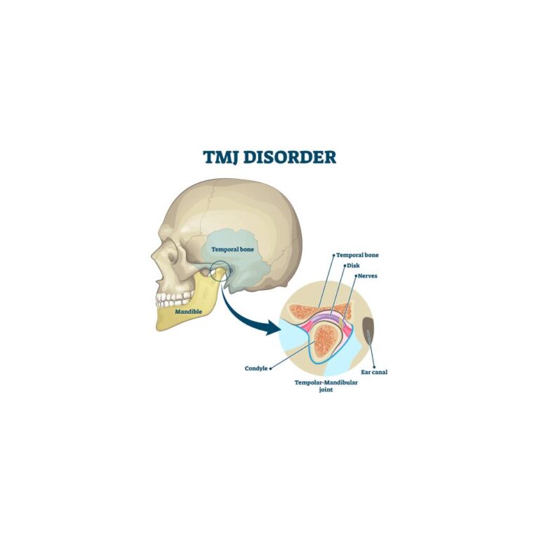 TMJ Disorder - Fairhope Dental Associates